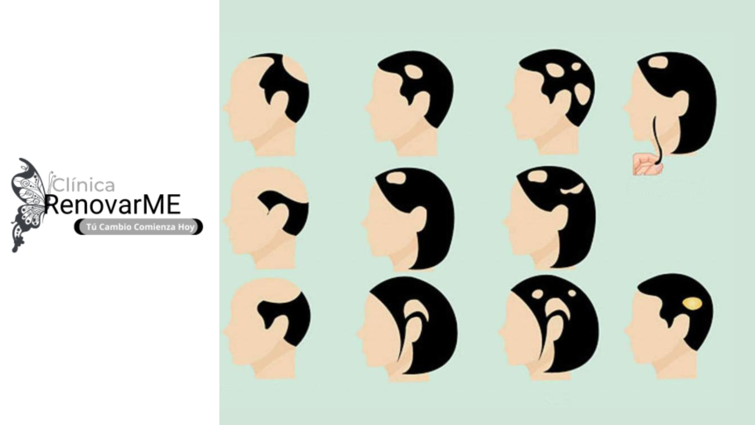 Caída del Cabello - Clinica RenovarMe