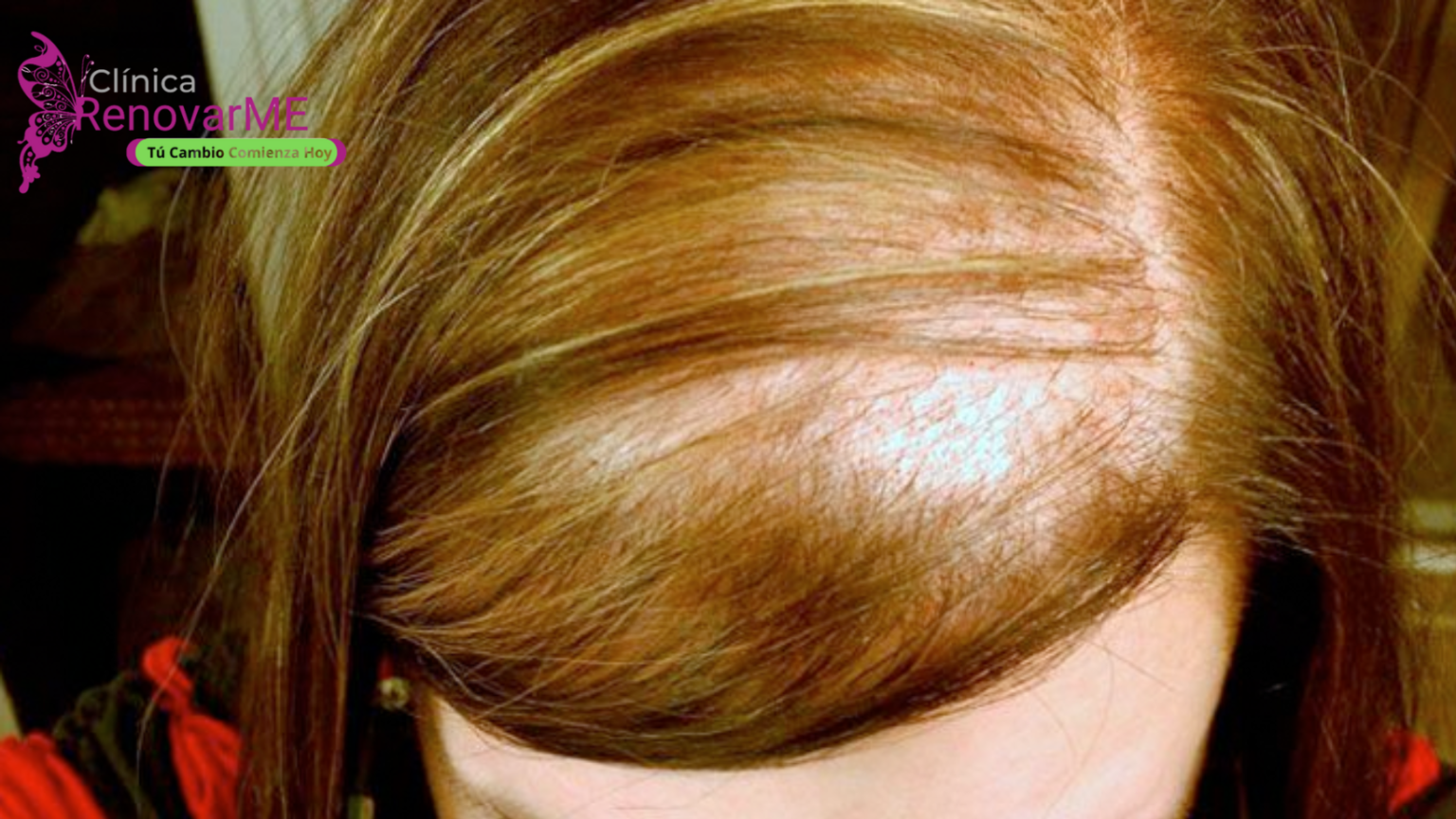 Caída del Cabello - Clinica RenovarMe